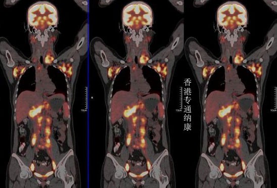 DS8201乳腺癌骨转移单次治疗剂量香港上市中文说明_财富号_东方财富网