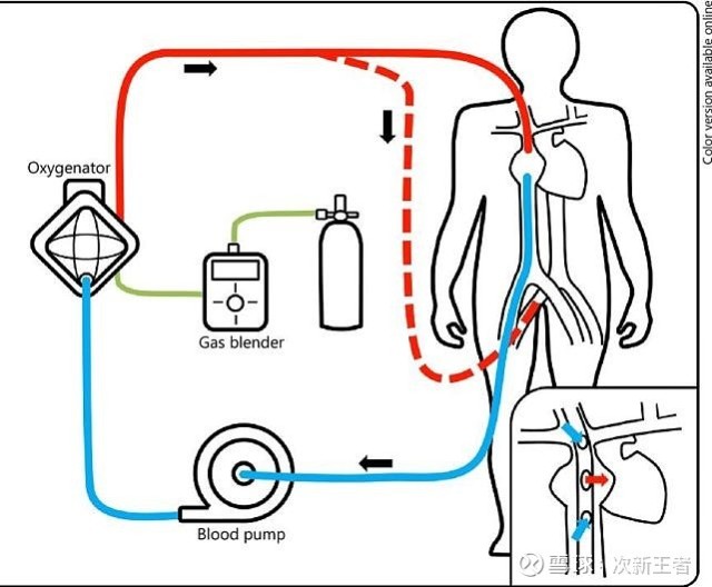国产高性能ECMO，实现重大突破_财富号_东方财富网