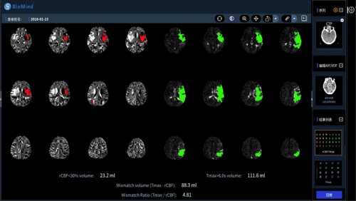 中天医疗携手安德医智，完善脑卒中AI诊断与机械抽吸治疗方案_财富号_东方财富网